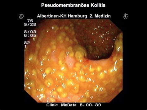 Pseudomembranous Colitis Doccheck
