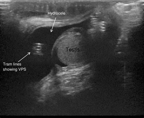 Fetal Hydrocele Ultrasound