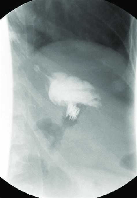 Upper Gi Study After Therapy Download Scientific Diagram