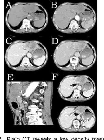 Figure 1 From A Case Of Intrahepatic Cholangiocarcinoma Invasive To