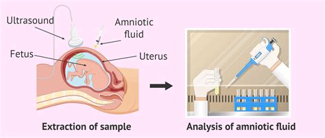 Amniocentesis Diagram