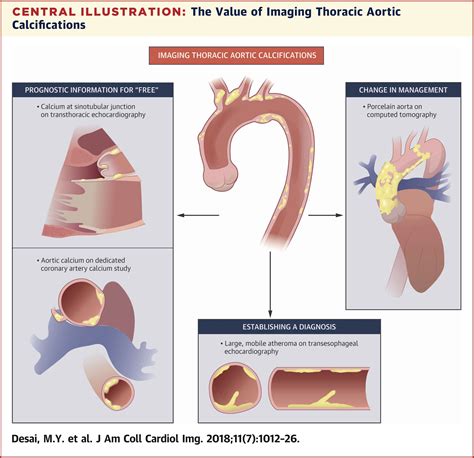 Thoracic Aortic Calcification Diagnostic Prognostic And Management