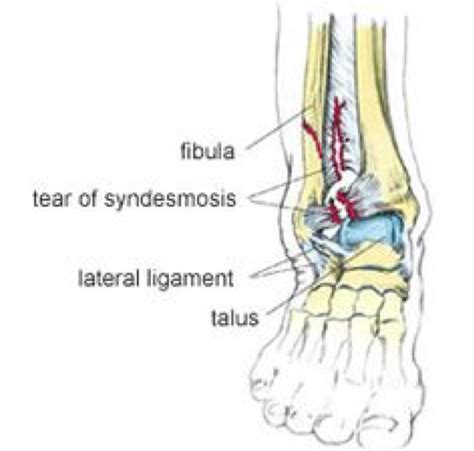 Recurrent Ankle Injuries And Balance Training — Brookvale Physio Hprs