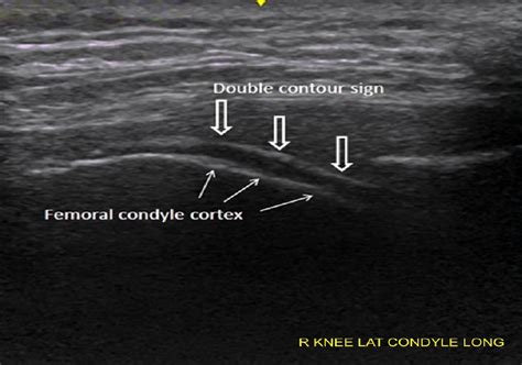 [pdf] Factors Influencing Acute Gout Factors Contributing To Increase In Risk Of Acute Gout