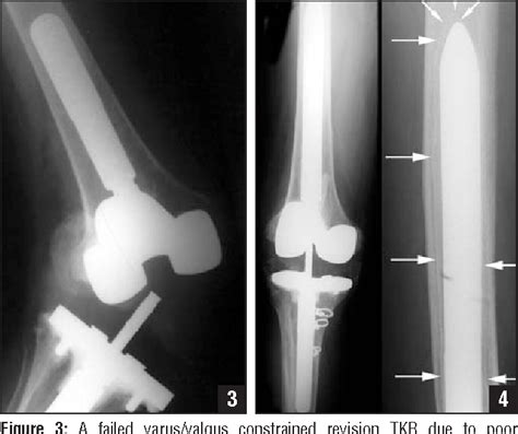 Figure 3 From The Role Of Implant Constraint In Revision Total Knee Replacement Striking The