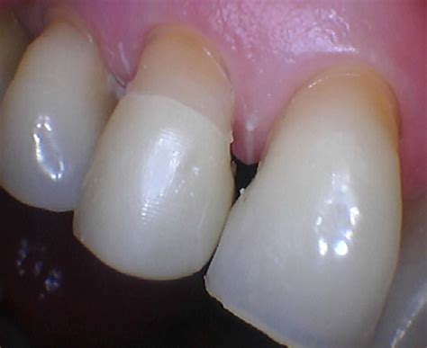 Using Technology Reliable Cementation Methods To Deliver Great Clinical Results