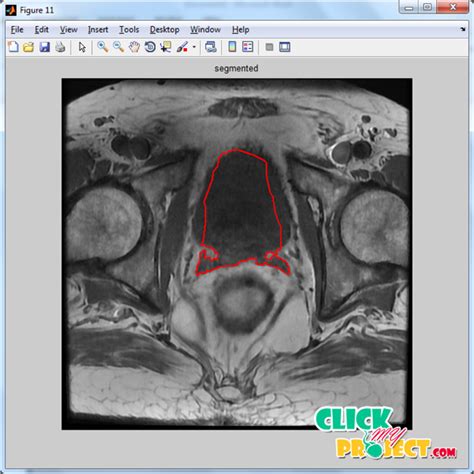 Computer Aided Detection Of Prostate Cancer In Mri Clickmyproject