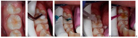 Biomimetic Enamel Regeneration Using Self Assembling Peptide P11 4