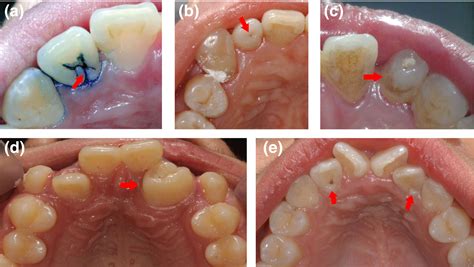 An Update On The Diagnosis And Treatment Of Dens Invaginatus Zhu