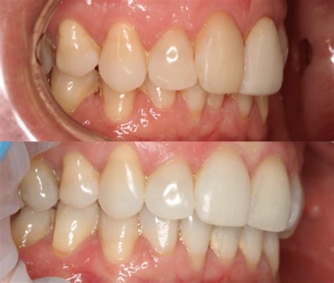 Clearcorrect Clear Braces Sutton Coldfield Sutton Dental