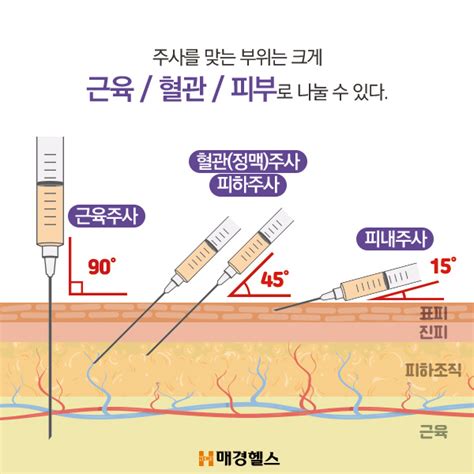 알테오젠과 머크 인수 찌라시 ALT B4 피하주사 SC