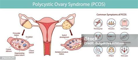 Polycystic Ovary Syndrome Pcos Ovarian Cysts Of The Female Reproductive