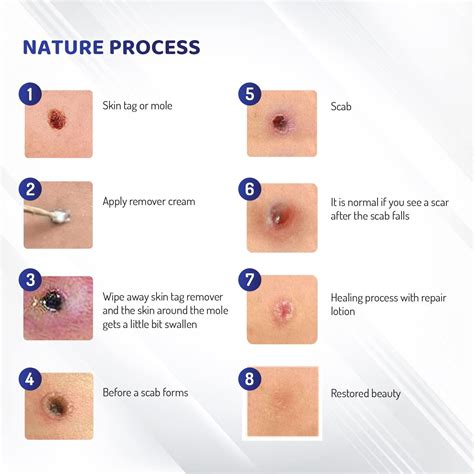 Mole Removal And Skin Tag Repair Gel Set Remove Effectively At Home
