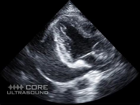 Subxiphoid Ultrasound
