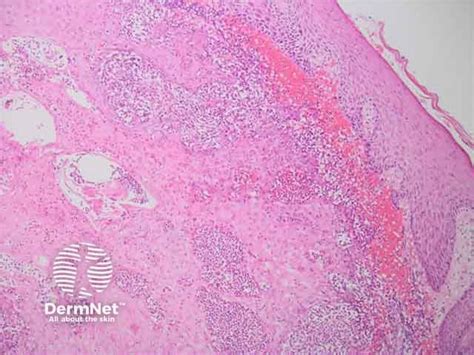Acute Myeloid Leukaemia Histopathology Image