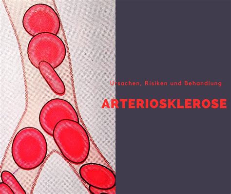 Arteriosklerose Ursachen Risiken Und Behandlung Kosmetikfuchs Magazin