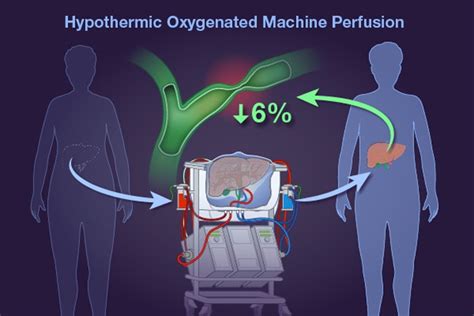 Hypothermic Machine Perfusion In Liver Transplantation Nejm Resident 360