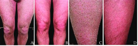 Ichthyosis‐like Atopic Dermatitis Before A And C And After B And D