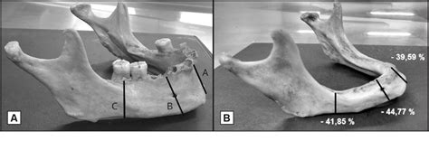 Figure 1 From Anatomical Variation In The Mandibular Foramen In Non Atrophic And Atrophic