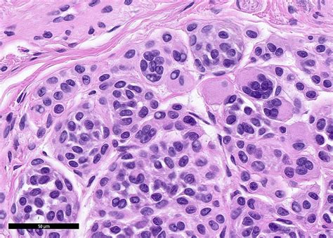 Pathology Outlines Nevi General