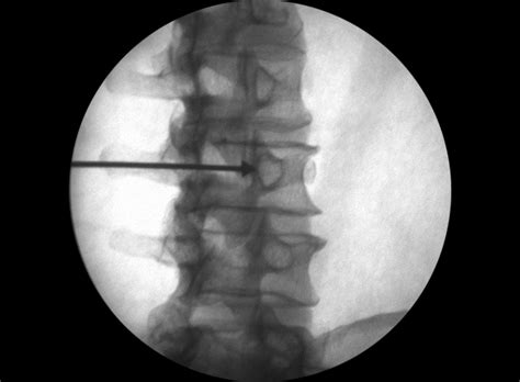 Now The Marker Is Removed And Needle Insertion Point For Download Scientific Diagram