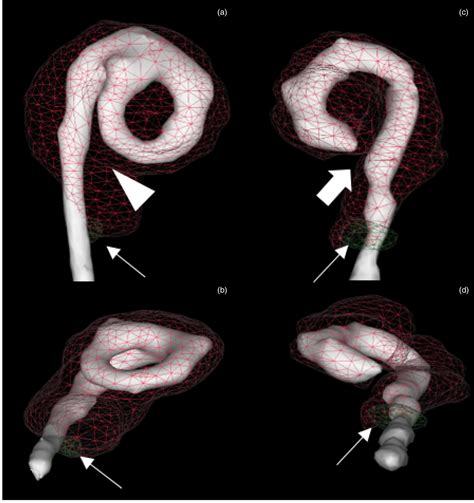 Surgical Considerations During Cochlear Implantation The Utility Of Temporal Bone Computed