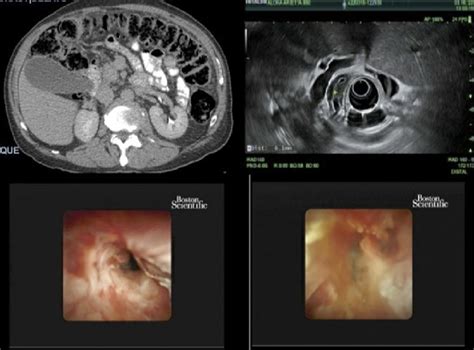 Top Ct Of Abdomen And Ercp Bottom Exploratory Laparotomy Download