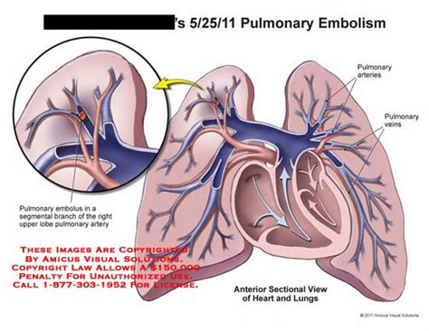 Pulmonary Embolism
