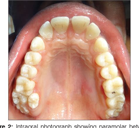 Figure 1 From Paramolar A Supernumerary Molar A Case Report And An