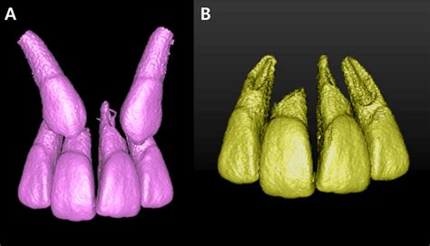 The Aspect Of Impaction And Root Resorption Using A 3d Simulation Download Scientific Diagram