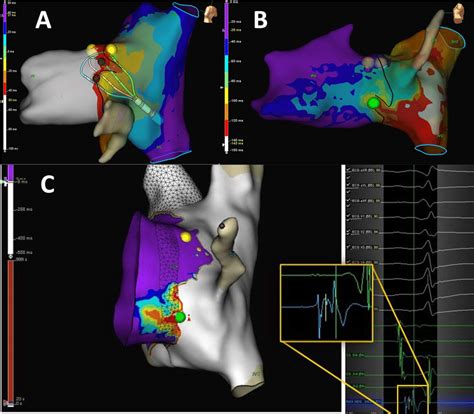 Three Dimensional Image Of The Grid Catheter At The Site Of Successful Download Scientific