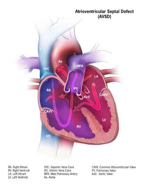 Congenital Heart Defects Teachmepaediatrics
