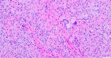 Dermatofibroma Pathology Outlines