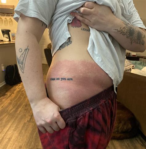 Lupus Rash Rautoimmune