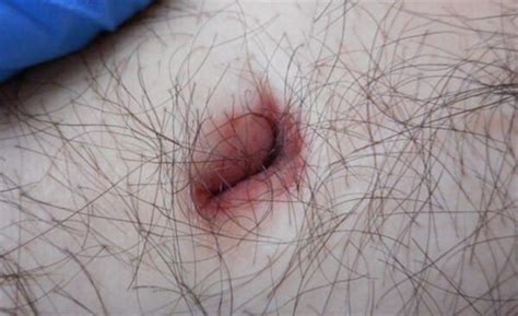 Perianal Streptococcal Dermatitis A Rash About The Umbilicus