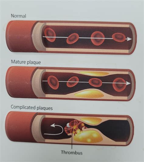 ‘혈관의 위험경고 이상지질혈증 방치하면 중증질환 초래