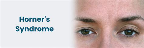 Horners Syndrome Causes Symptoms And Diagnosis