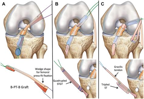 Patellar Tendon Graft