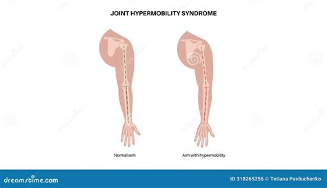 Joint Hypermobility Poster Vector Illustration