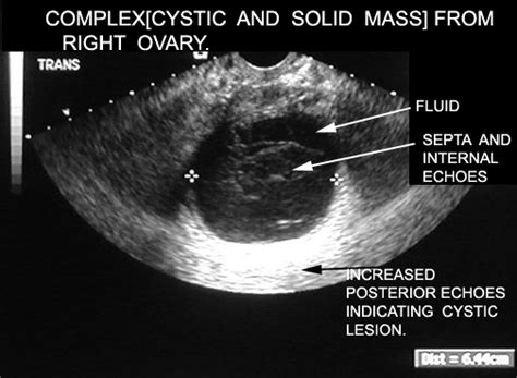 Any Solid Component On The Ultrasound Is A Possible Feature Of Malignancy