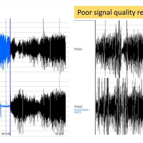 Distribution Of FPS R Scores The Blue Bars Indicate The FPS R Scores Download Scientific