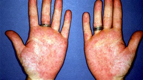 Palmar Erythema Medizzy