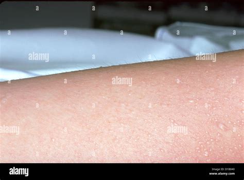 Blisters Stock Photo Alamy