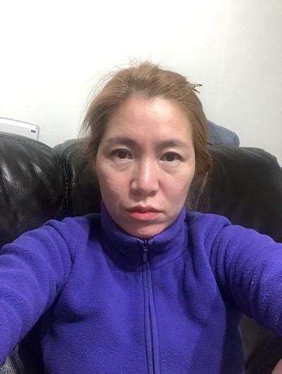 눈밑지방재배치 시술방법 선택 안함 시술・수술후기 By 준이2 바비톡