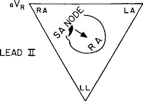 Figure 1 From The P Wave Morphology What Does It Tell Us Semantic Scholar