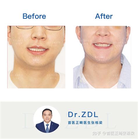 正畸案例嘴突下巴后缩缺失牙病例分享 知乎