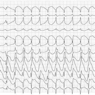 ECG After Month Showed That Corrected QT Interval Had Returned To Normal Download