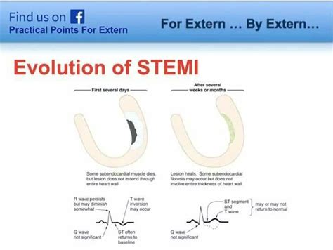 Evolution Of Stemi
