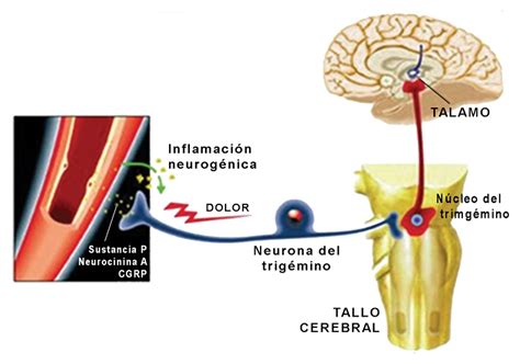 Fisiopatología De La Migraña Botica Digital Medical Magazine