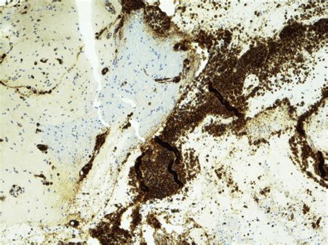 Cd20 Is A B‐cell Marker And Highlights The Prominent B‐cell Population